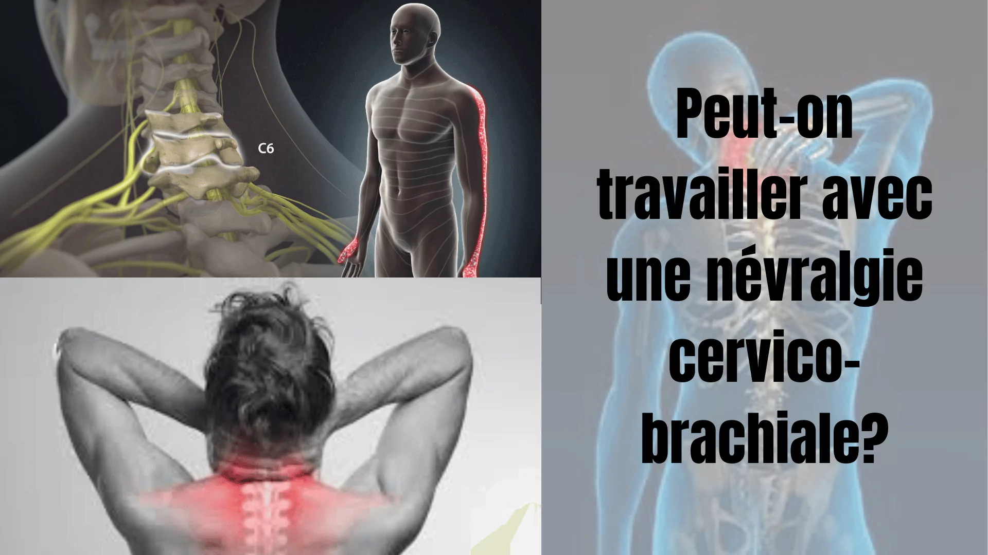 Peut-on travailler avec une névralgie cervico-brachiale